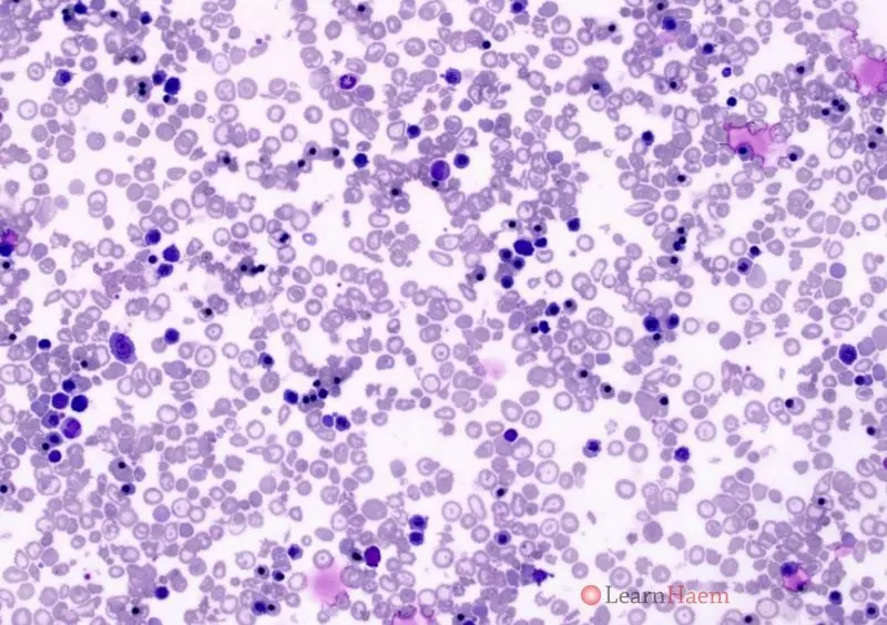 Haemoglobin Bart's Hydrops Fetalis - LearnHaem | Haematology Made Simple