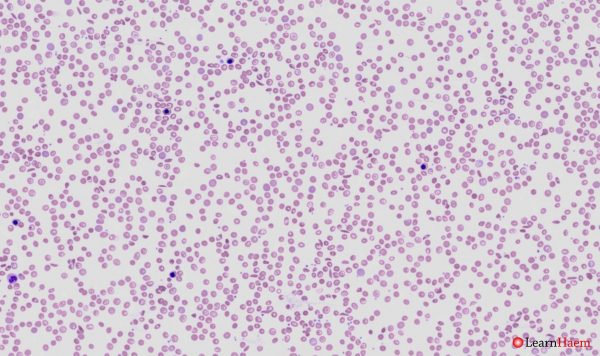 Thalassaemias and Haemoglobinopathies - LearnHaem | Haematology Made Simple