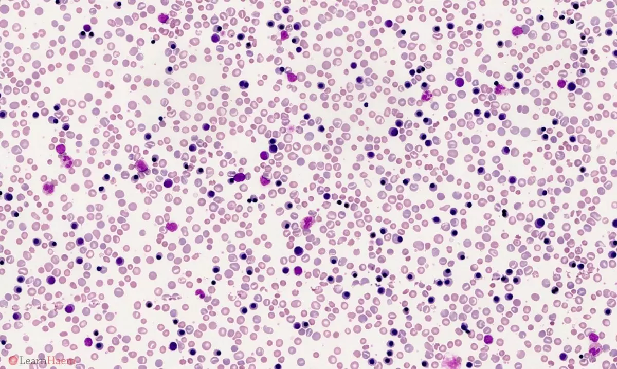 Haemolytic Disease of the Newborn - LearnHaem | Haematology Made Simple