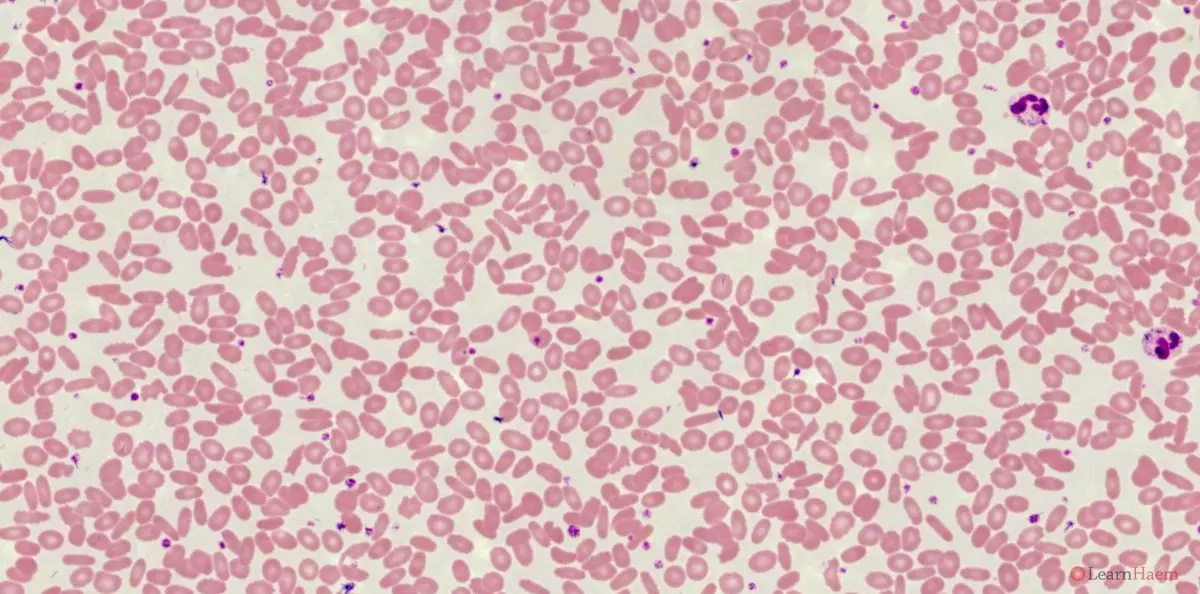 Hereditary Elliptocytosis - LearnHaem | Haematology Made Simple