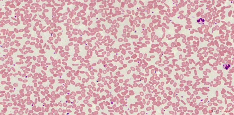 Hereditary Elliptocytosis - LearnHaem | Haematology Made Simple