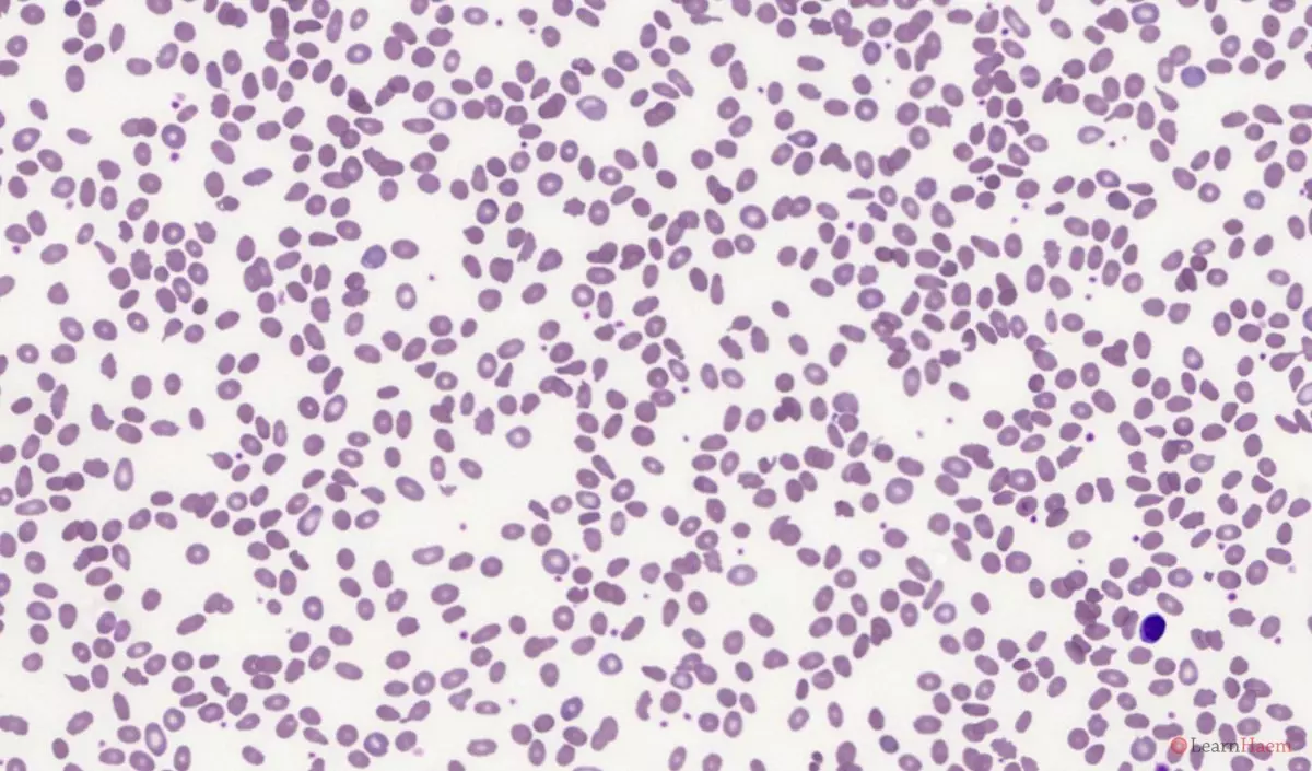 Hereditary Pyropoikilocytosis - LearnHaem | Haematology Made Simple