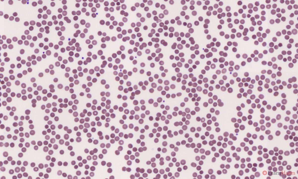 Hereditary Spherocytosis - LearnHaem | Haematology Made Simple