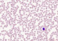 Iron Deficiency - LearnHaem | Haematology Made Simple