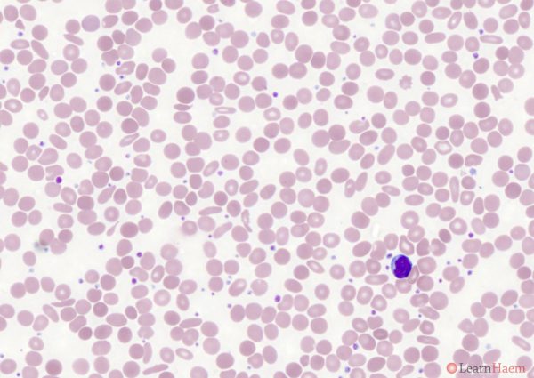 Iron Deficiency - LearnHaem | Haematology Made Simple