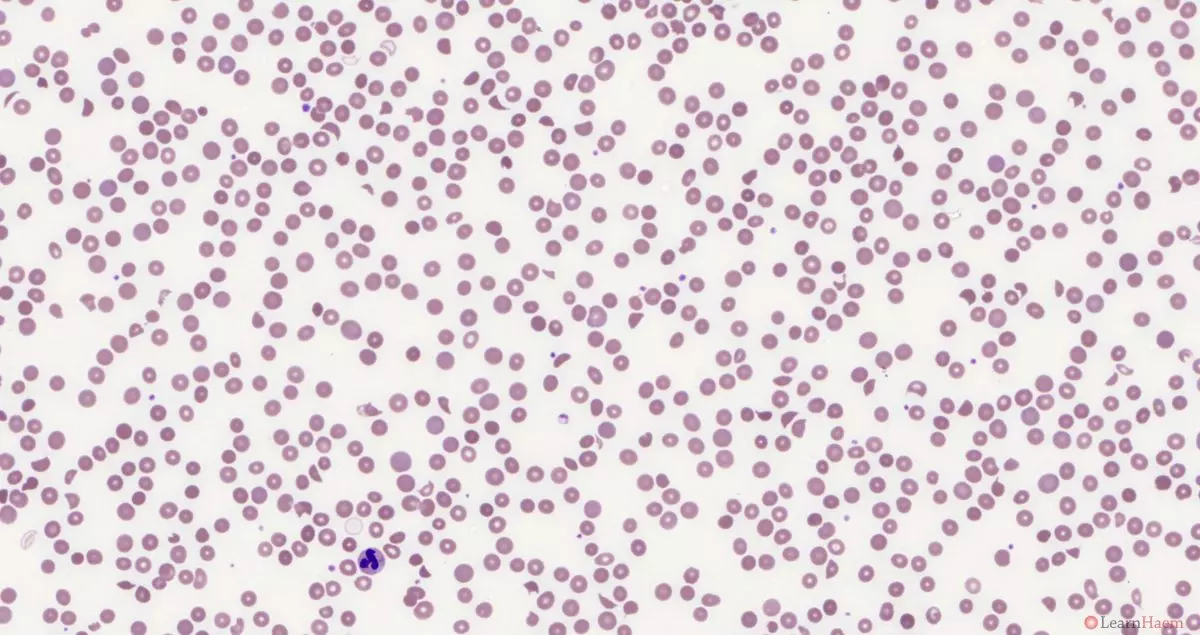 Microangiopathic Haemolytic Anaemia - LearnHaem | Haematology Made Simple