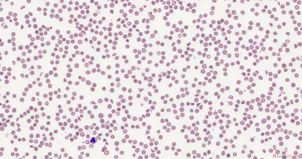 Microangiopathic Haemolytic Anaemia - LearnHaem | Haematology Made Simple