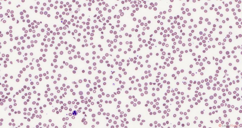 Microangiopathic Haemolytic Anaemia - LearnHaem | Haematology Made Simple