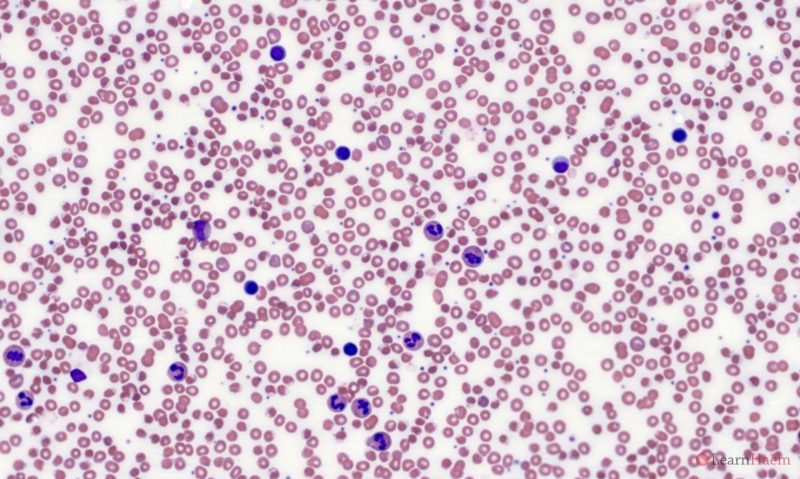 Oxidative Haemolysis - LearnHaem | Haematology Made Simple