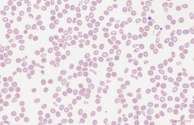 Sickle Cell Anaemia - LearnHaem | Haematology Made Simple