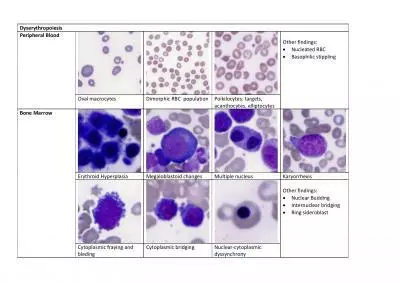 MDS Overview - LearnHaem | Haematology Made Simple