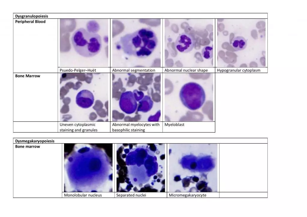 MDS Overview - LearnHaem | Haematology Made Simple