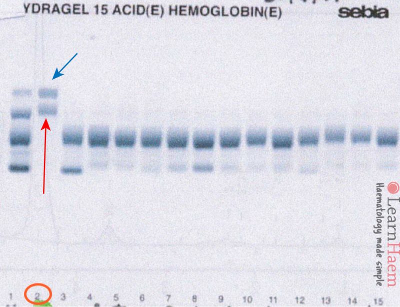 Haemoglobin SC Disease - LearnHaem | Haematology Made Simple