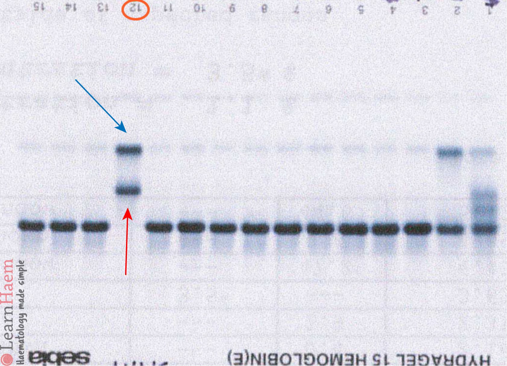 Haemoglobin SC Disease - LearnHaem | Haematology Made Simple