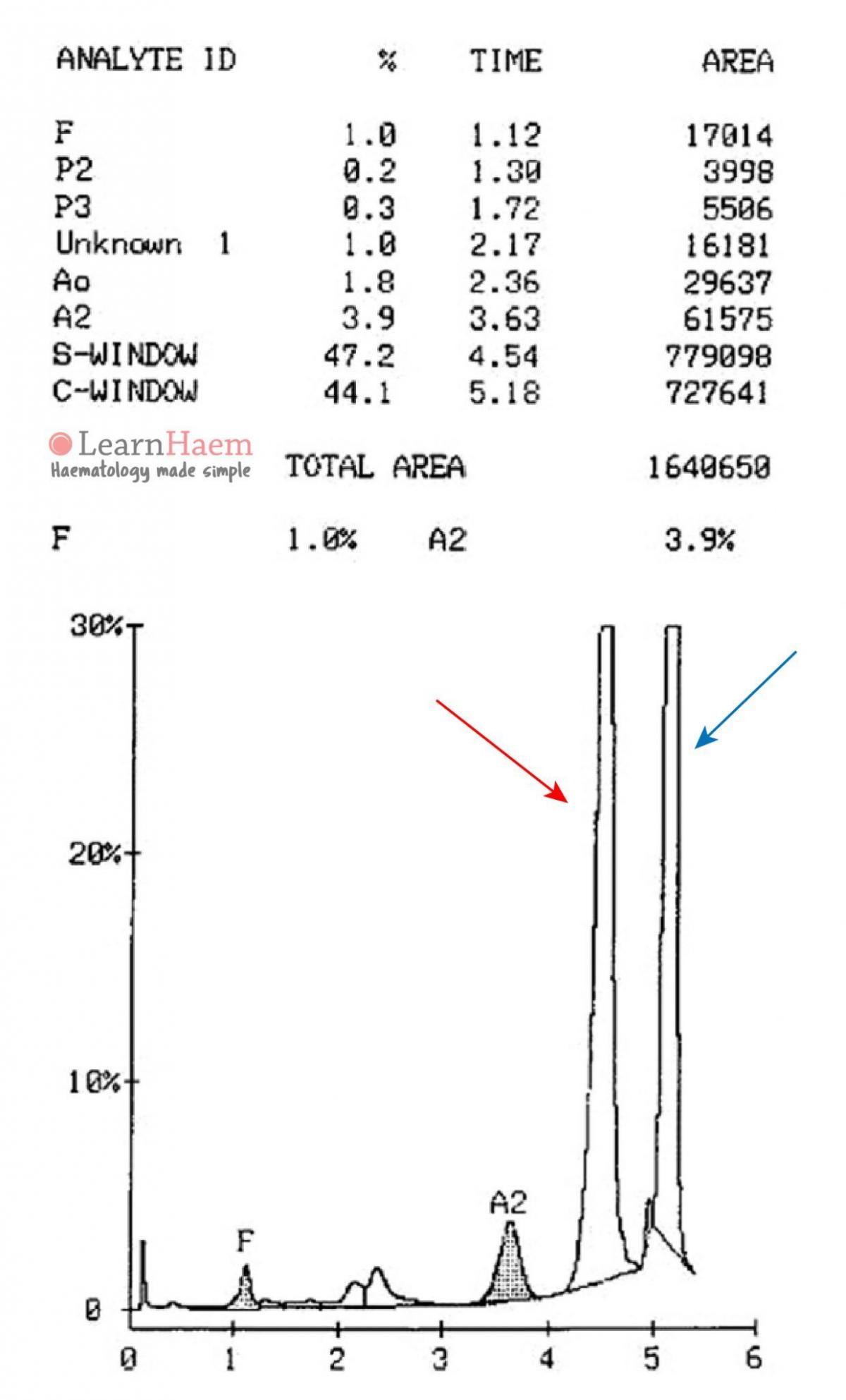 Haemoglobin SC Disease - LearnHaem | Haematology Made Simple