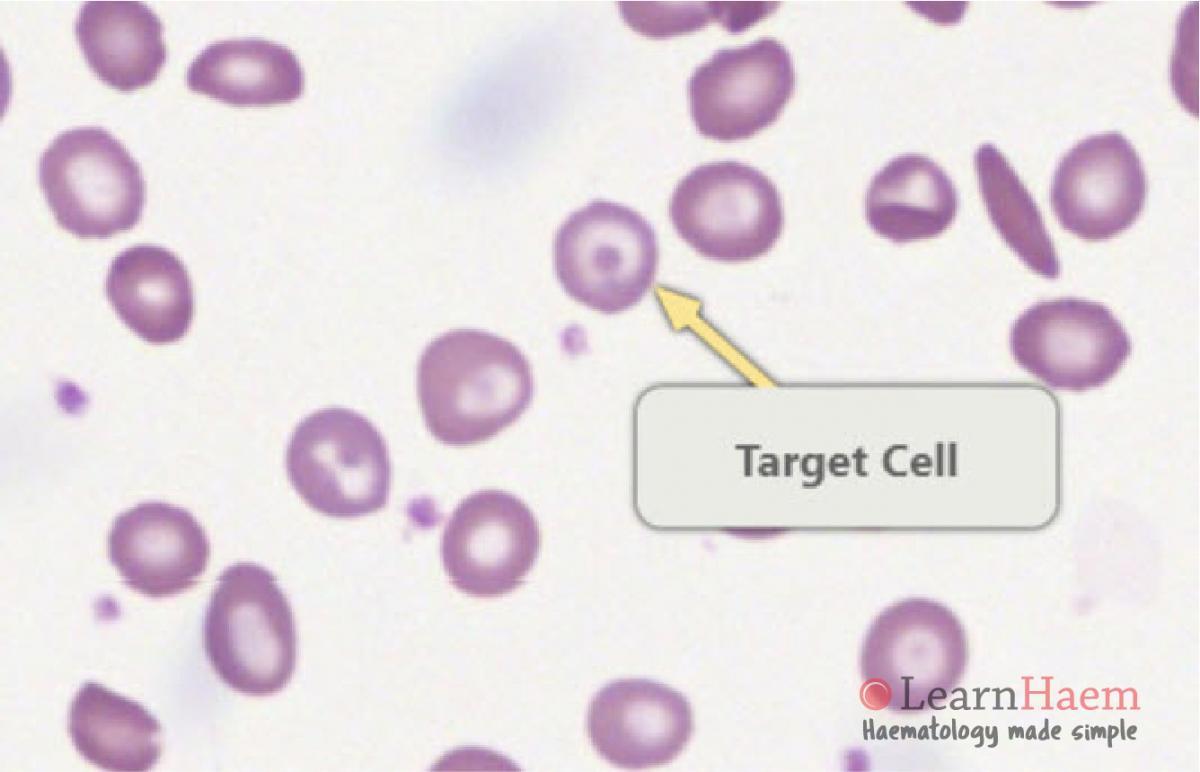 Target Cells LearnHaem Haematology Made Simple
