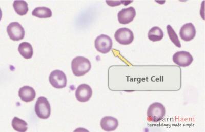 Target Cells - LearnHaem | Haematology Made Simple