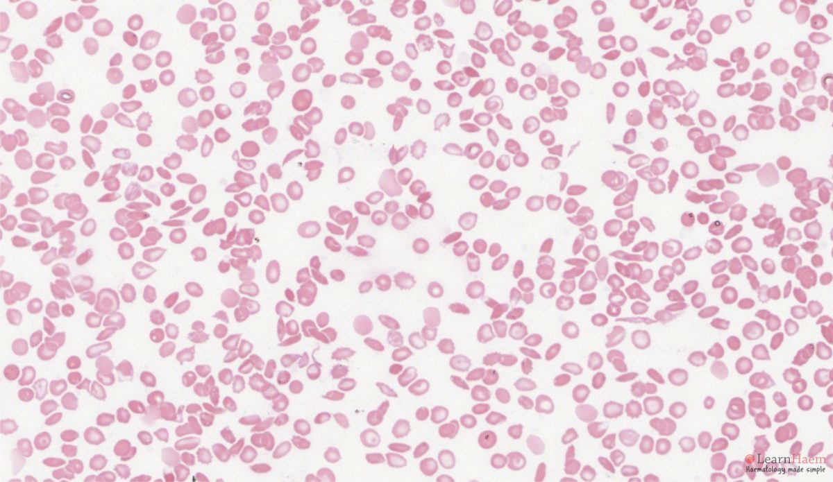 Haemoglobin S / D-Punjab - LearnHaem | Haematology Made Simple