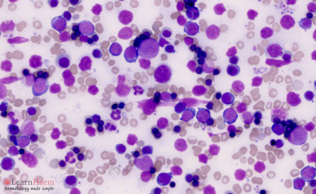 AML M6 - Pure Erythroid Leukaemia - LearnHaem | Haematology Made Simple