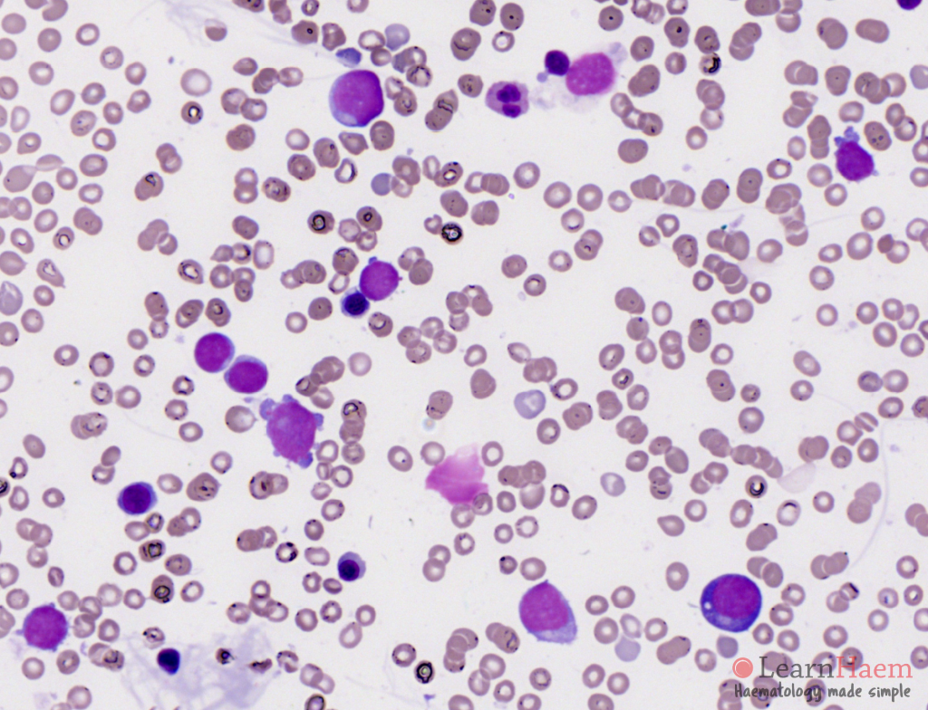 AML M7 - Acute Megakaryoblastic Leukaemia - LearnHaem | Haematology ...