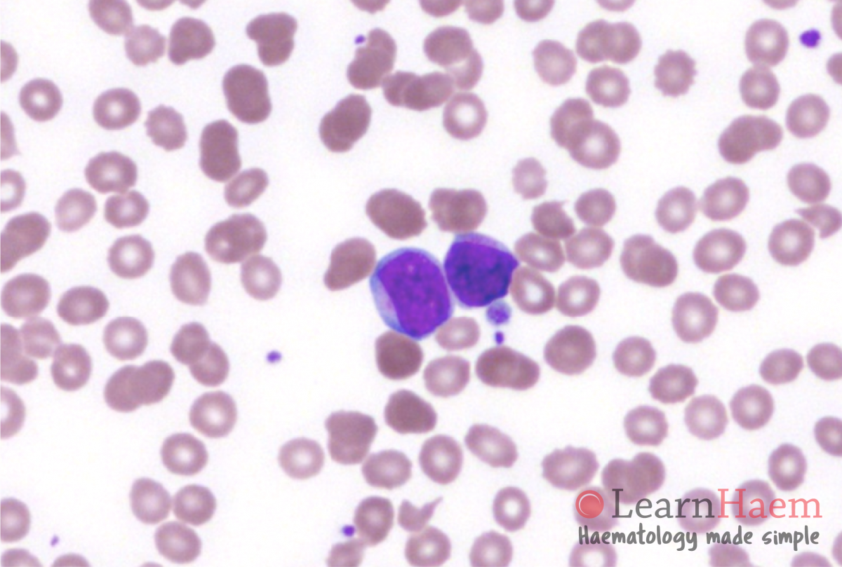 Acute Myeloid Leukaemia - LearnHaem | Haematology Made Simple