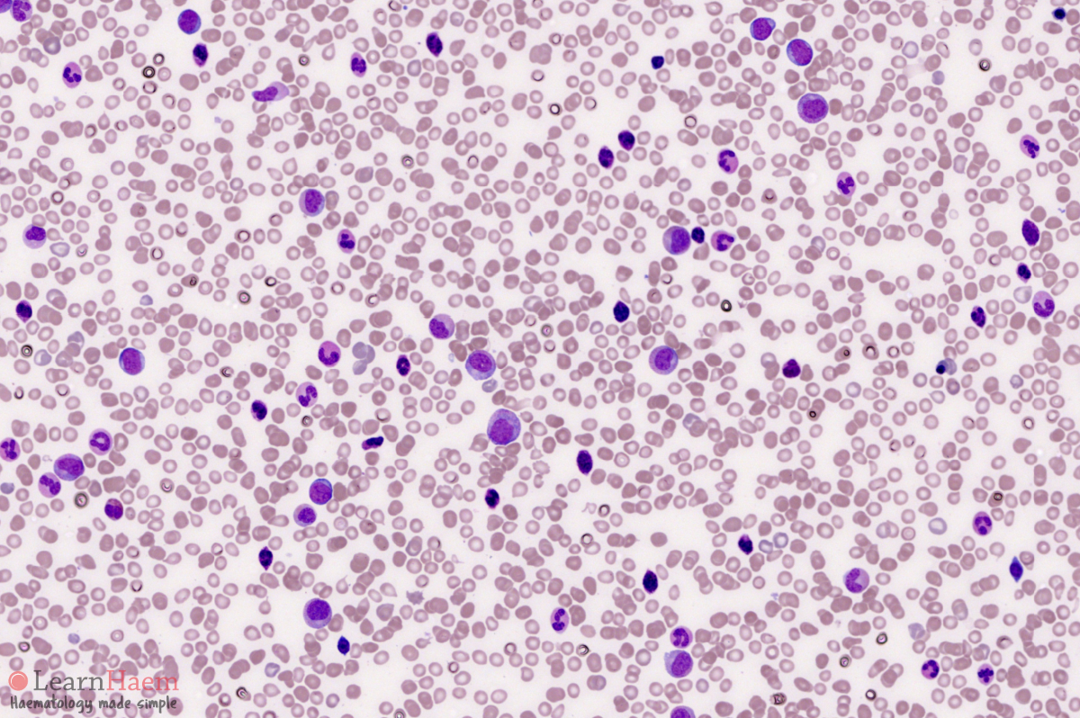 CML in Accelerated Phase - LearnHaem | Haematology Made Simple