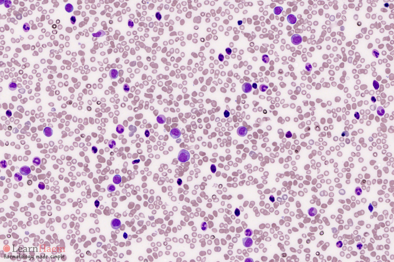 CML in Accelerated Phase - LearnHaem | Haematology Made Simple