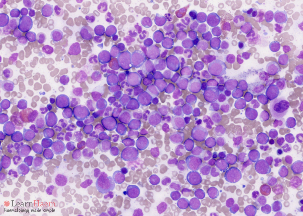 CML in Blast Phase - LearnHaem | Haematology Made Simple
