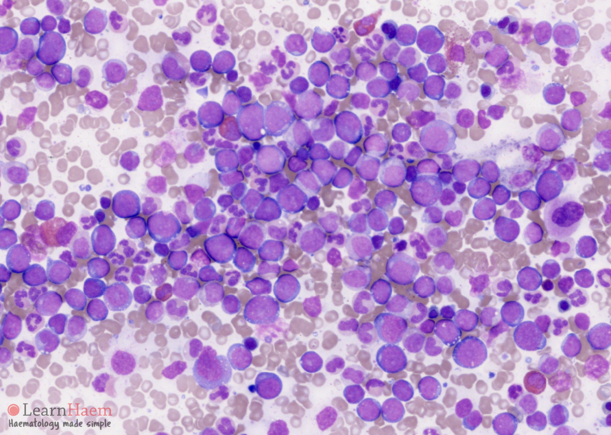 CML in Blast Phase - LearnHaem | Haematology Made Simple