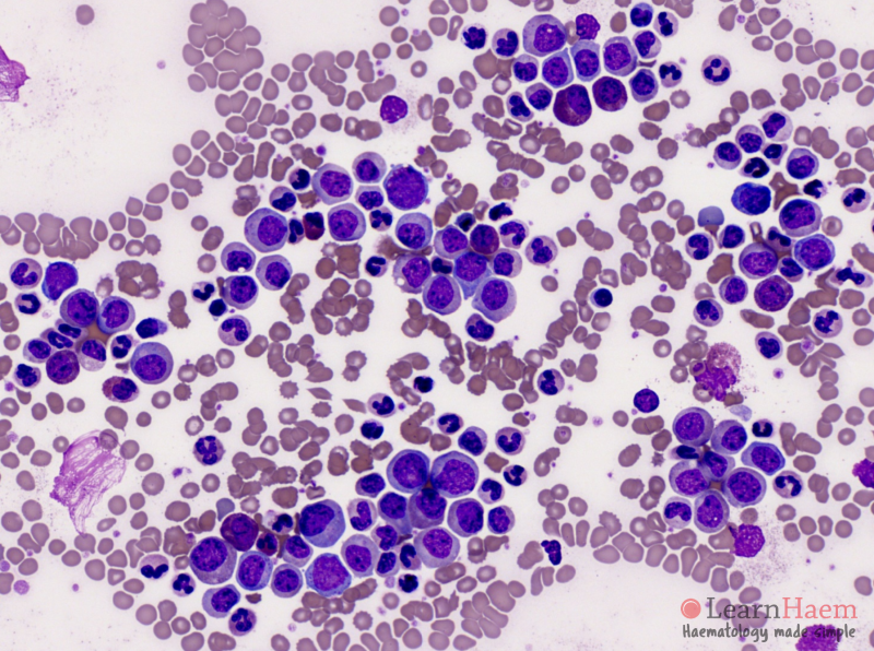 CML in Chronic Phase - LearnHaem | Haematology Made Simple