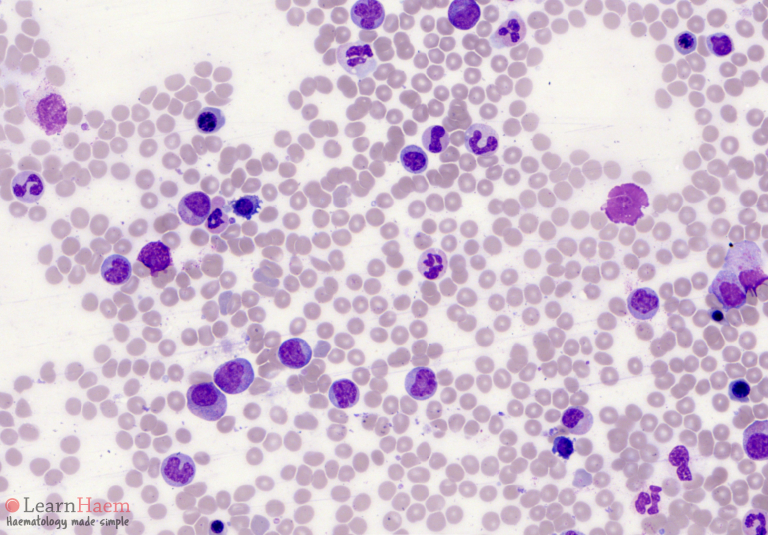Chronic Myelomonocytic Leukaemia - LearnHaem | Haematology Made Simple