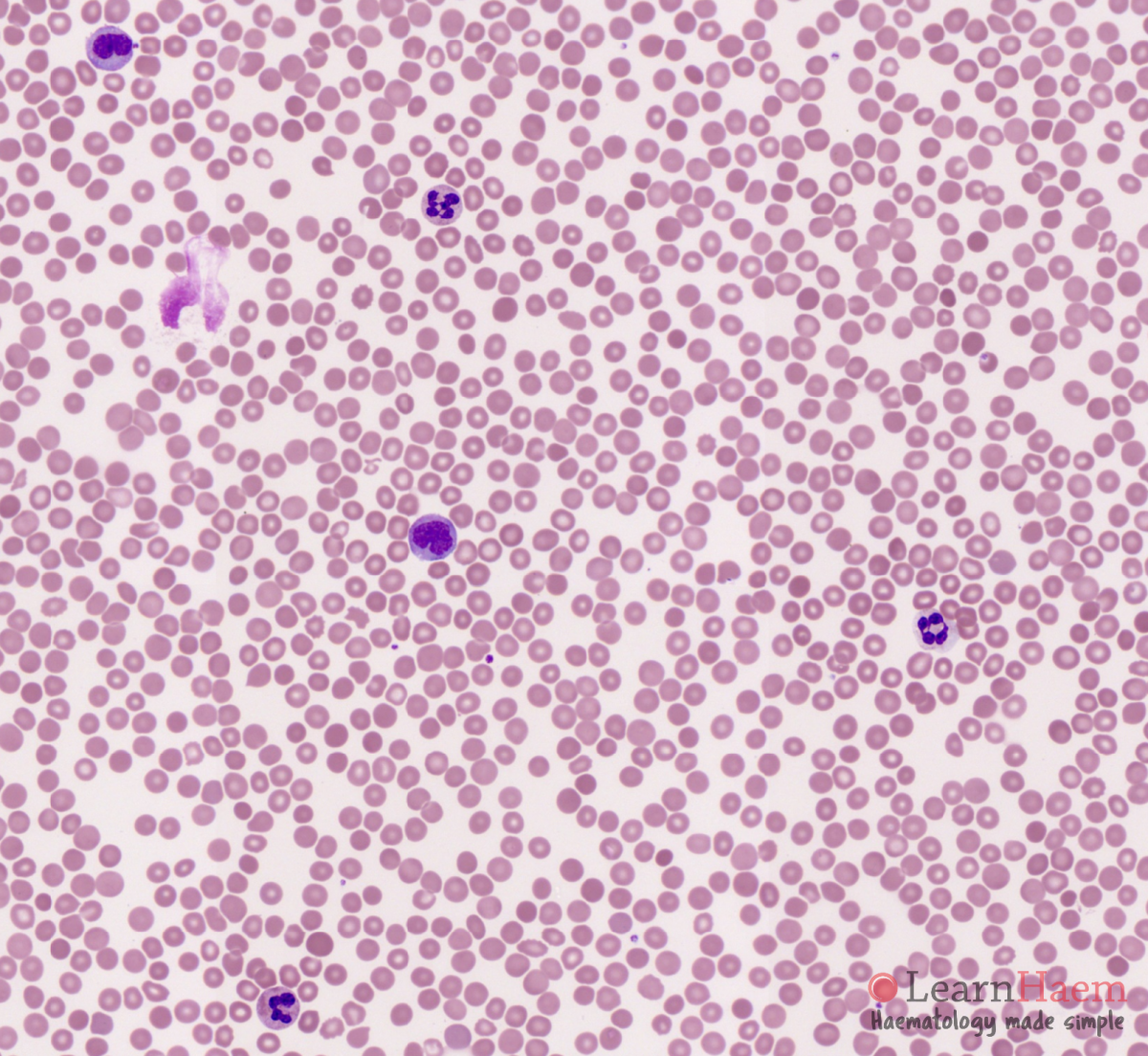 Chronic Myelomonocytic Leukaemia - LearnHaem | Haematology Made Simple