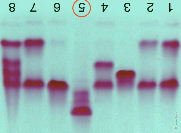 Haemoglobin Bart's Hydrops Fetalis - LearnHaem | Haematology Made Simple