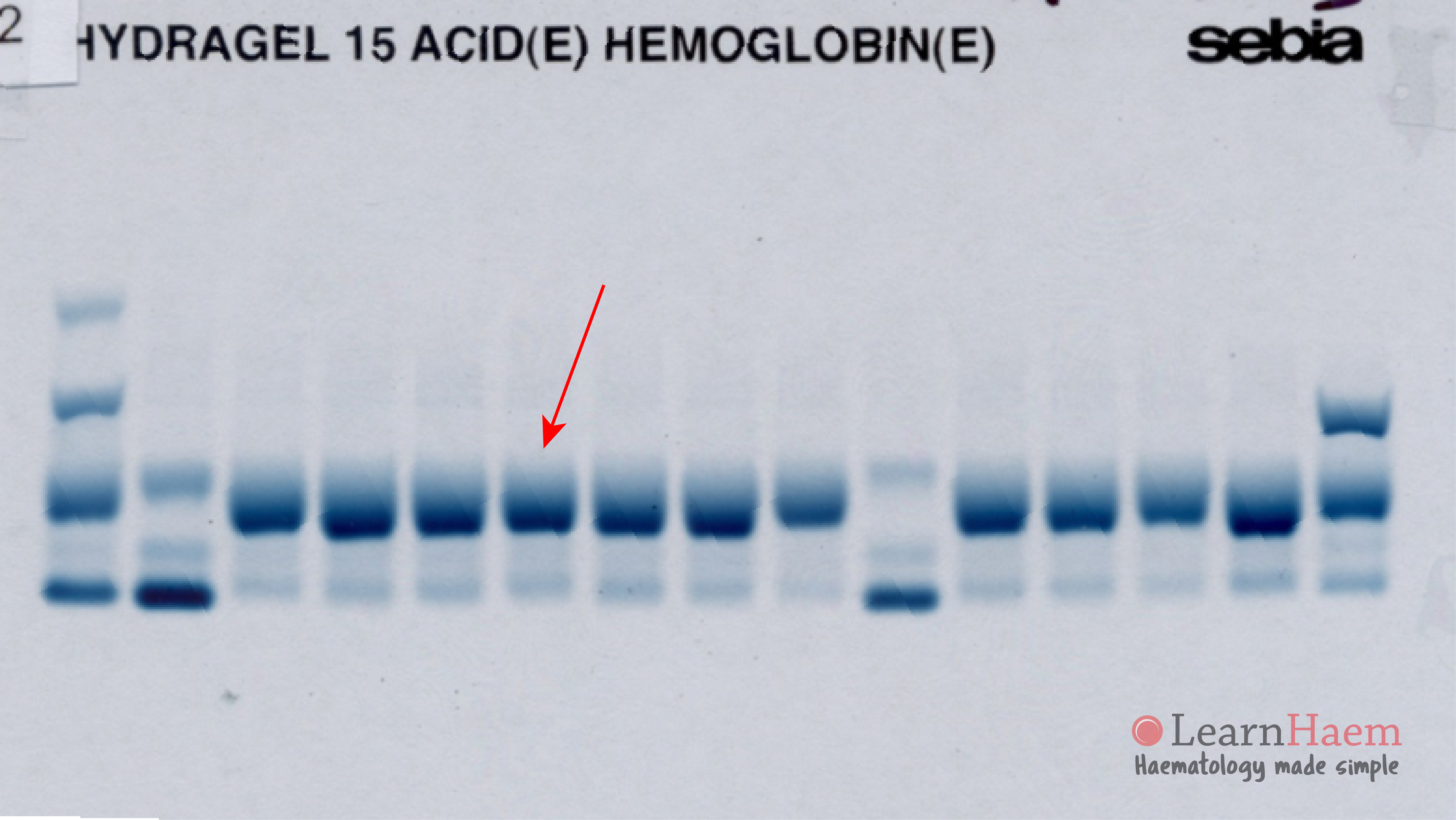 Haemoglobin E - LearnHaem | Haematology Made Simple