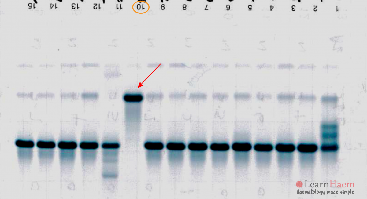 Haemoglobin E - LearnHaem | Haematology Made Simple