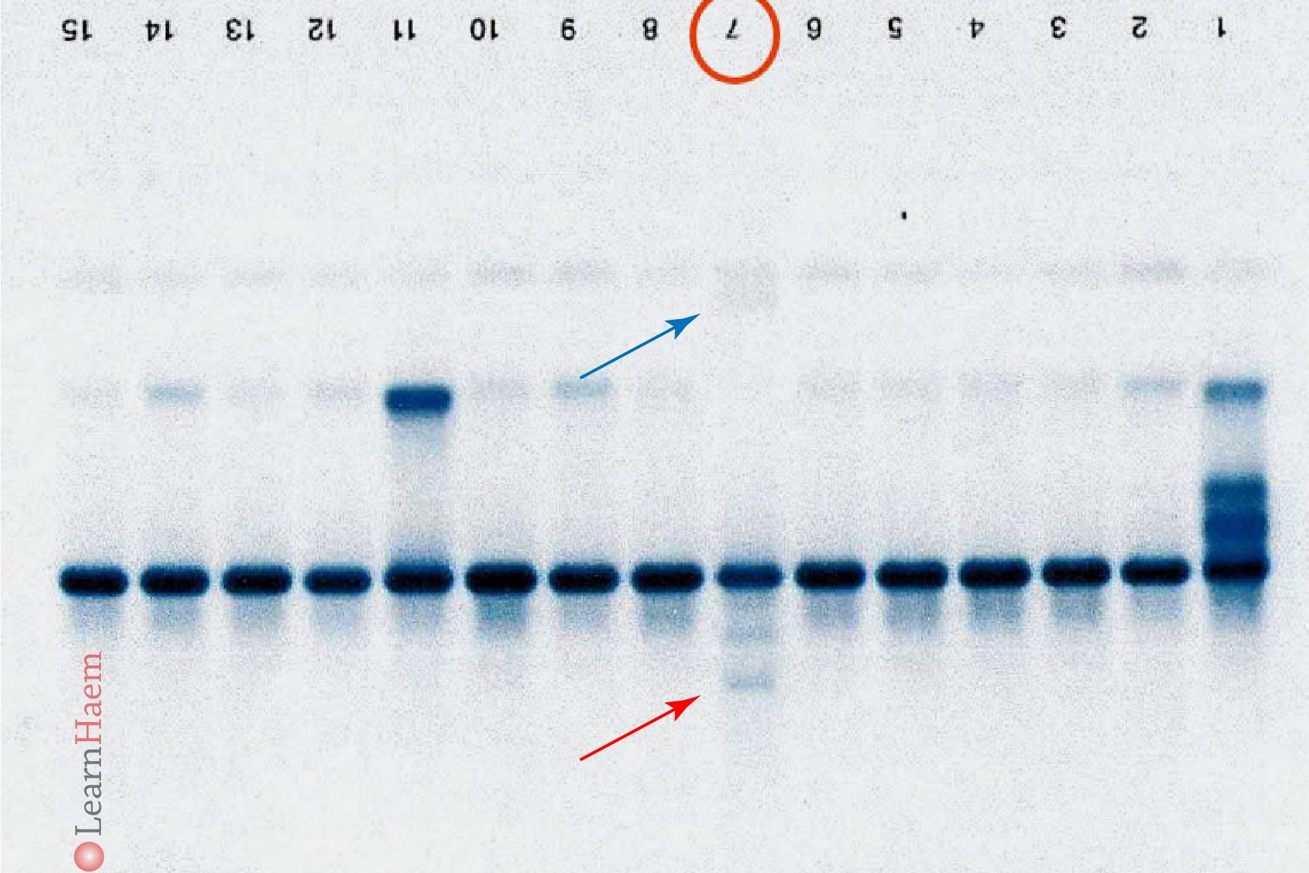 Haemoglobin H-Constant Spring Disease - LearnHaem | Haematology Made Simple