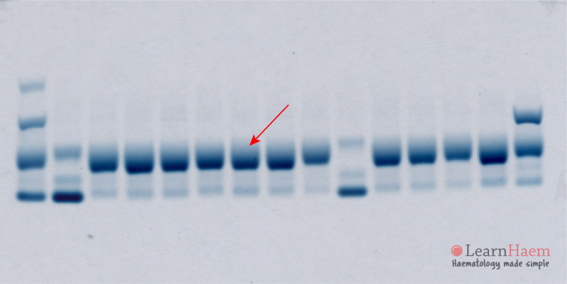 Haemoglobin Lepore - LearnHaem | Haematology Made Simple