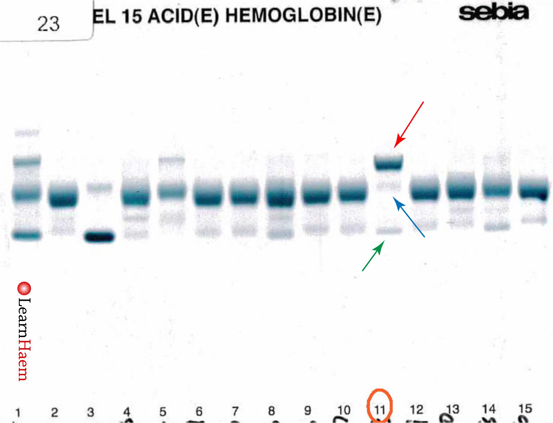 Haemoglobin S / Beta Thalassaemia (Sß) - LearnHaem | Haematology Made ...