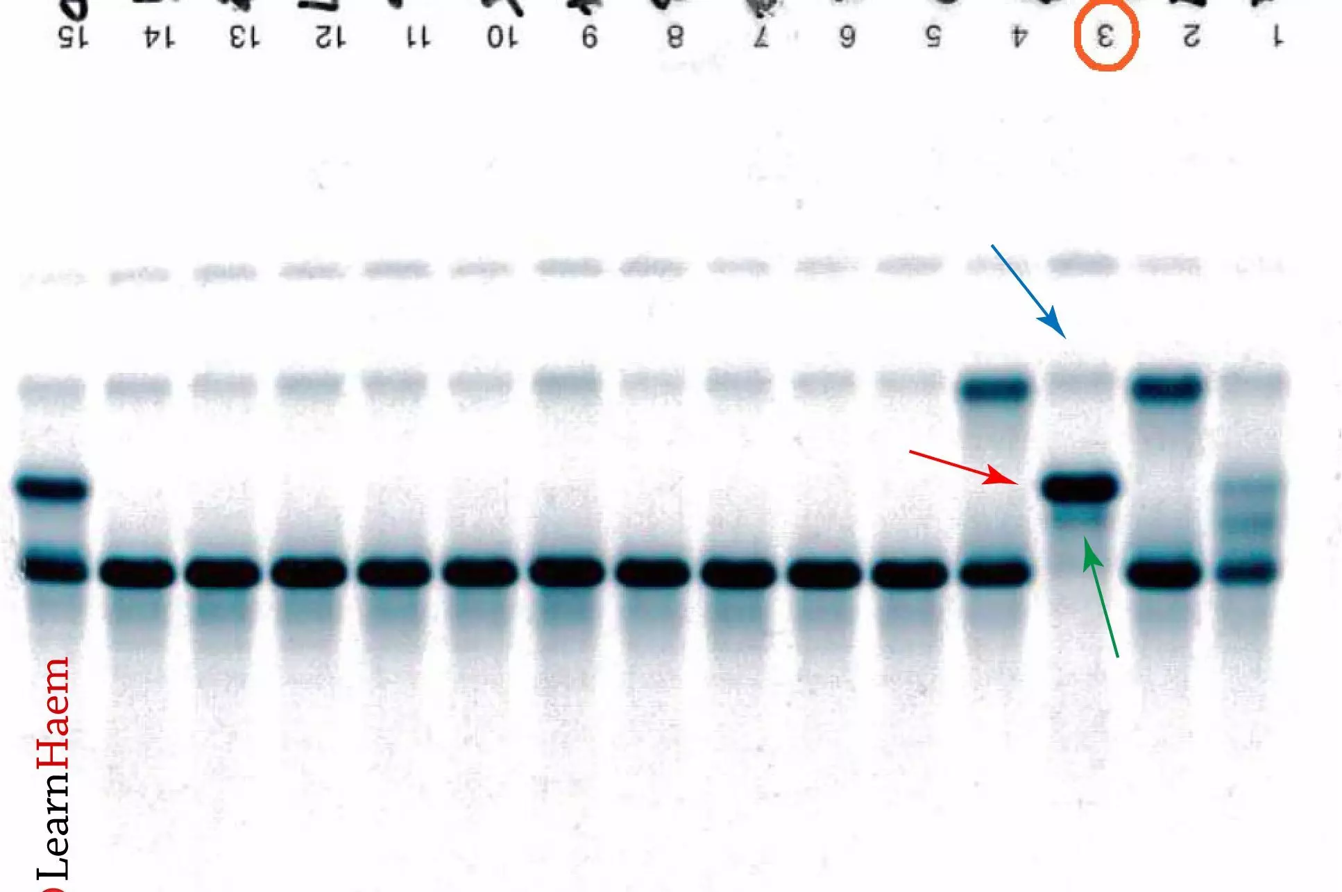 Haemoglobin S / Beta Thalassaemia (Sß) - LearnHaem | Haematology Made ...