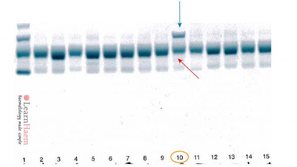 Haemoglobin S / D-Punjab - LearnHaem | Haematology Made Simple