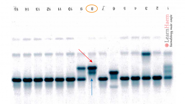 Haemoglobin S / D-Punjab - LearnHaem | Haematology Made Simple