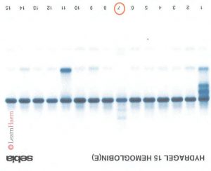 Haemoglobin H (HbH) Disease - LearnHaem | Haematology Made Simple