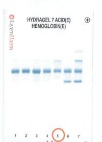Haemoglobin H-Constant Spring Disease - LearnHaem | Haematology Made Simple