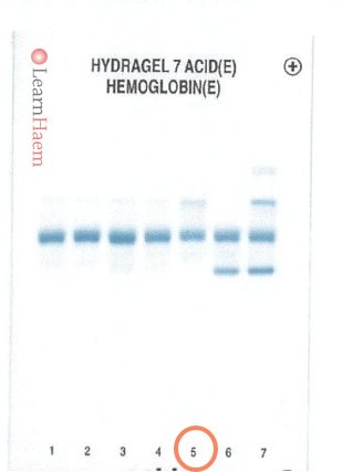 Haemoglobin H-Constant Spring Disease - LearnHaem | Haematology Made Simple