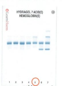 Haemoglobin H (HbH) Disease - LearnHaem | Haematology Made Simple