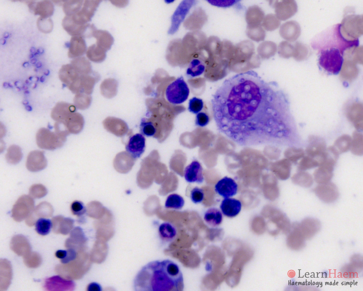 Histoplasmosis Learnhaem Haematology Made Simple