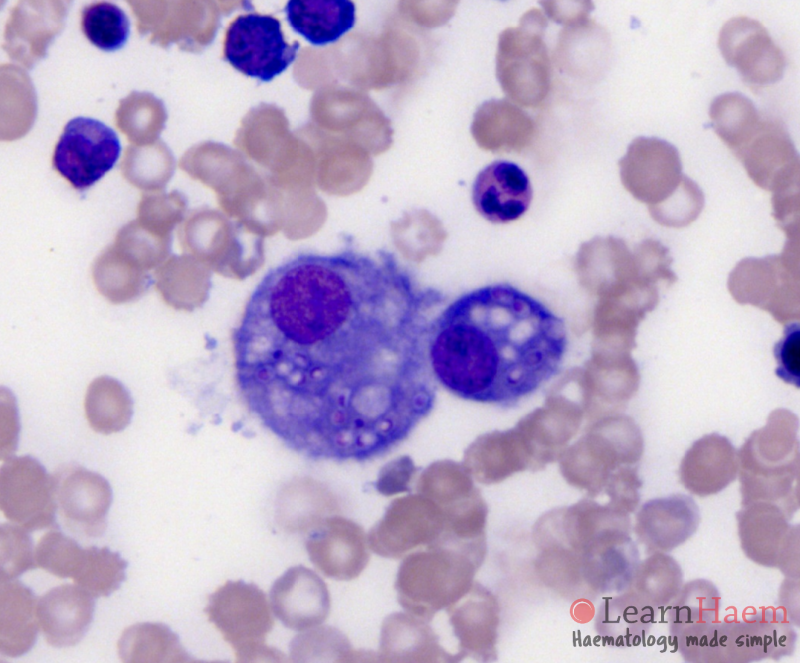 Histoplasmosis - LearnHaem | Haematology Made Simple
