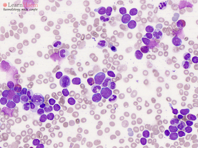 Mixed Phenotype Acute Leukaemia - LearnHaem | Haematology Made Simple