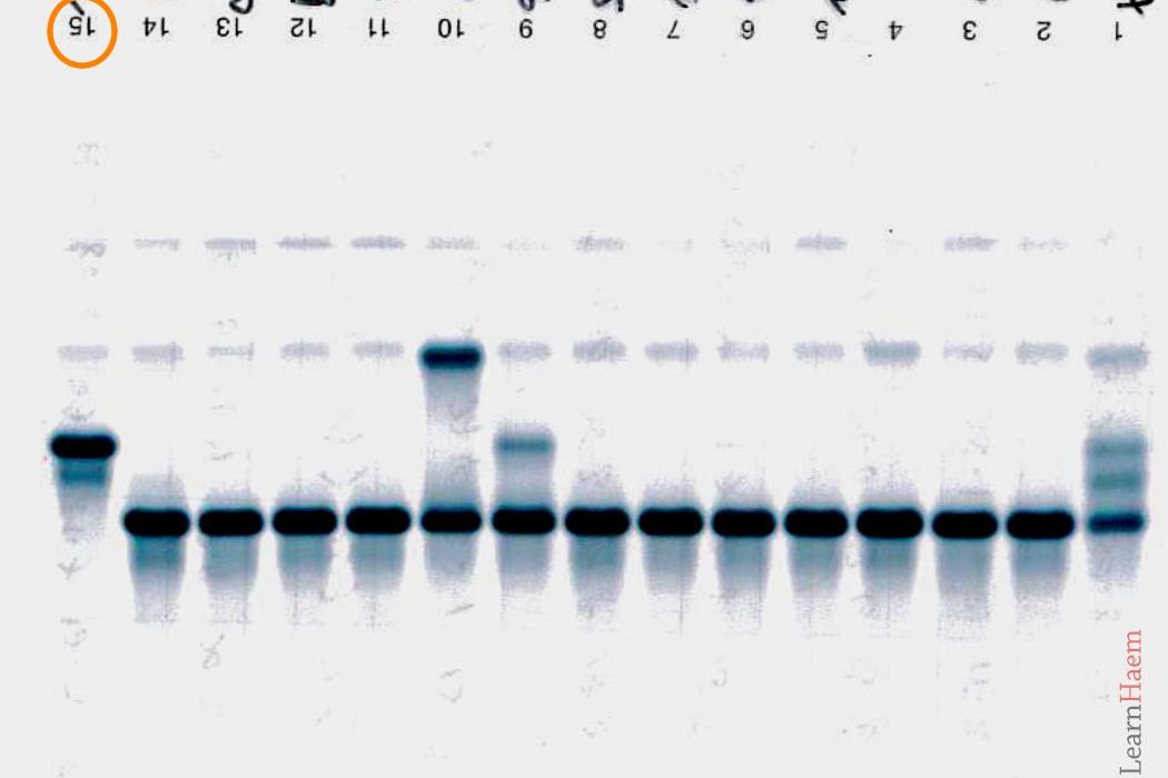 Sickle Cell Anaemia - LearnHaem | Haematology Made Simple