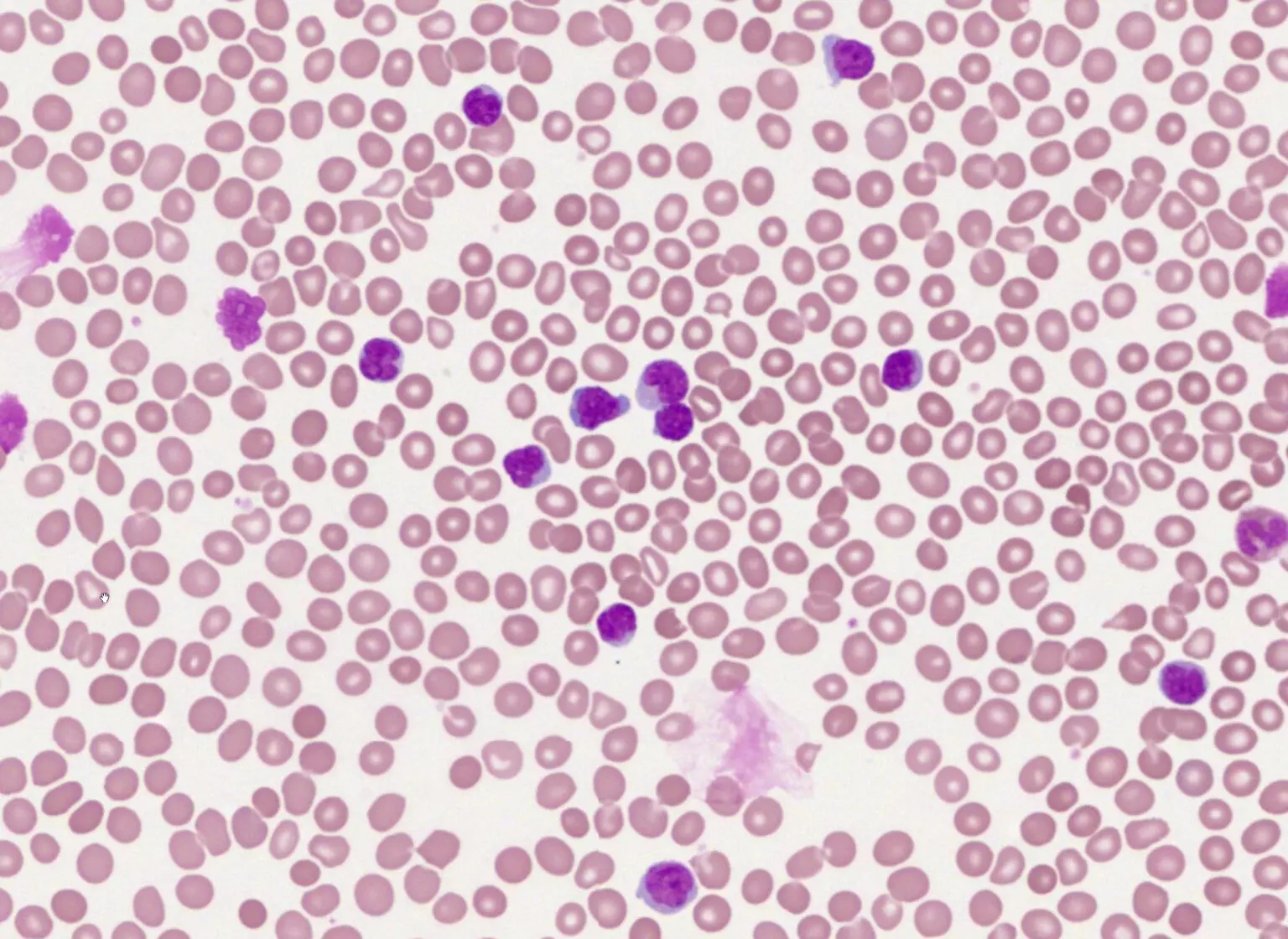 Adult T-Cell Leukaemia/Lymphoma - LearnHaem | Haematology Made Simple